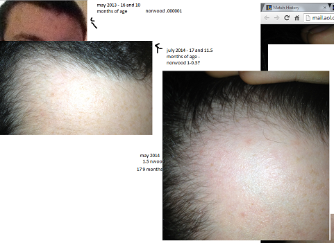 few questions - can dht sensitivity vary person to person? dutasteride ...