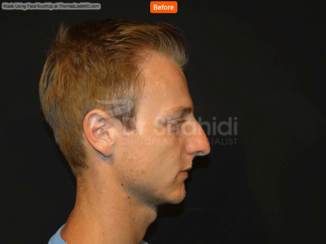 The cause for most rhinoplasties is recessed maxilla | Looksmax.org ...