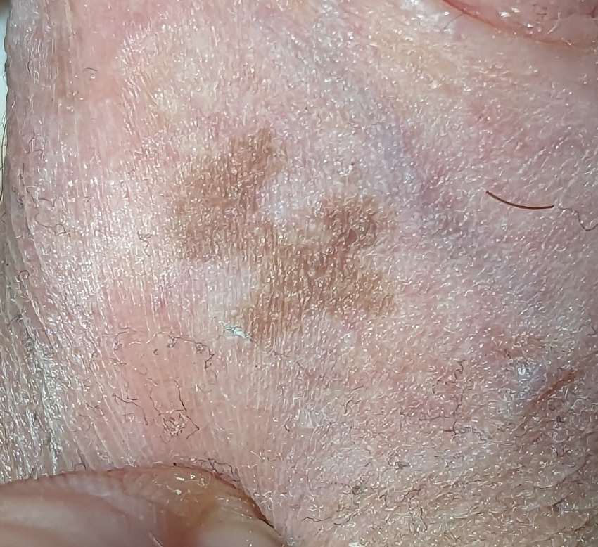 Can anyone identify this discolouration on my penis? 24M. : r ...