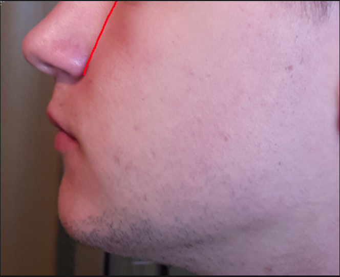 Is my lower jaw recessed? | Looksmax.org - Men's Self-Improvement ...