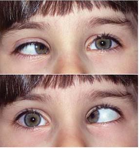 ELI5: How does people with Strabismus (eye disease) see the world? : r ...