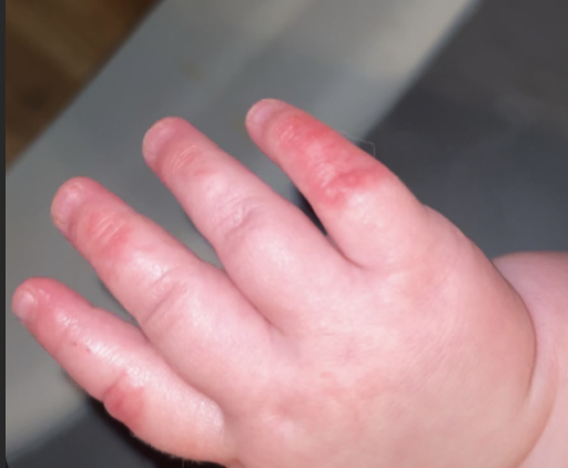 7 month old daughter sudden rash on hands : r/NewParents