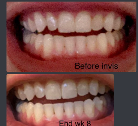 5 Weeks to Go : r/Invisalign