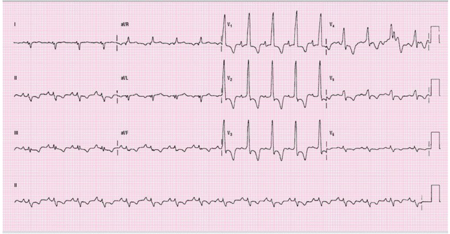 Concordance/discordance on EKG : r/EKGs
